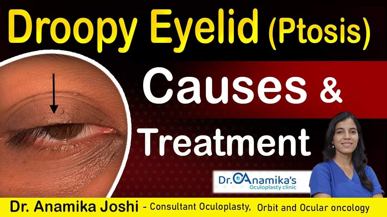 Droopy eyelid causes and treatment | Ptosis | Dr Anamika Joshi - YouTube
