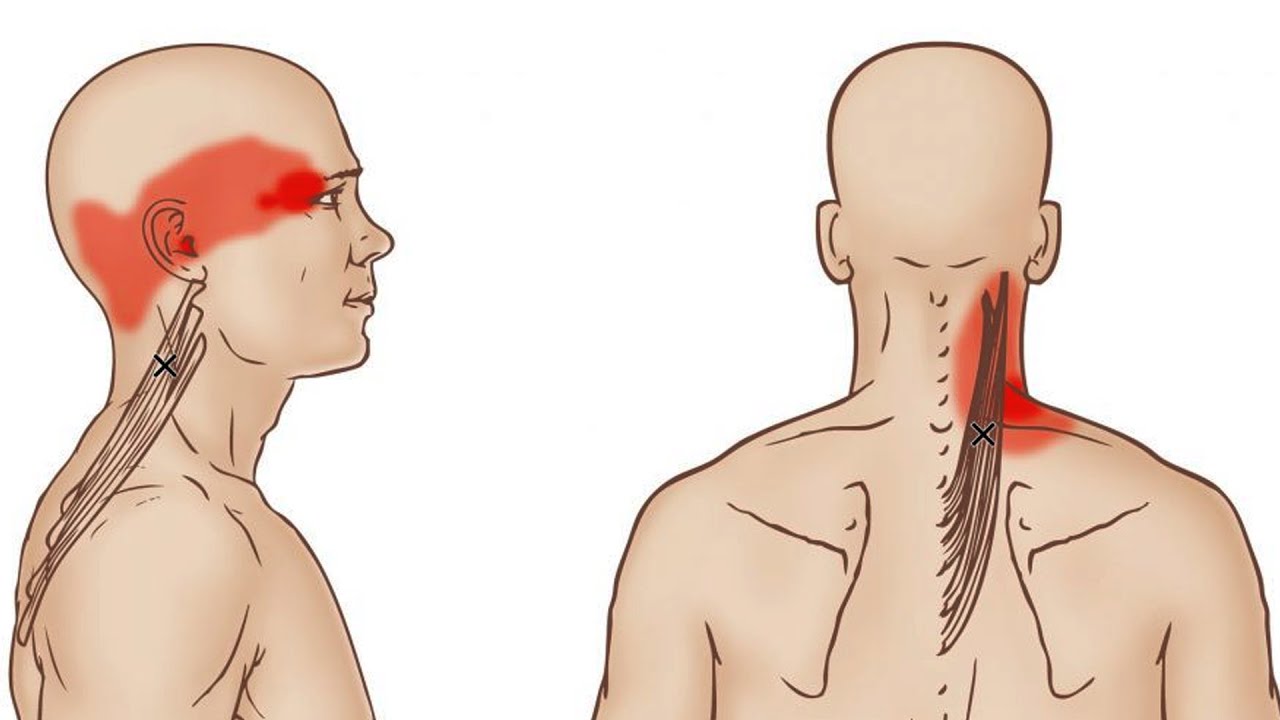 Head Pian /Neck Pain /Splenius Capitis Tigger Point Release Massage ...