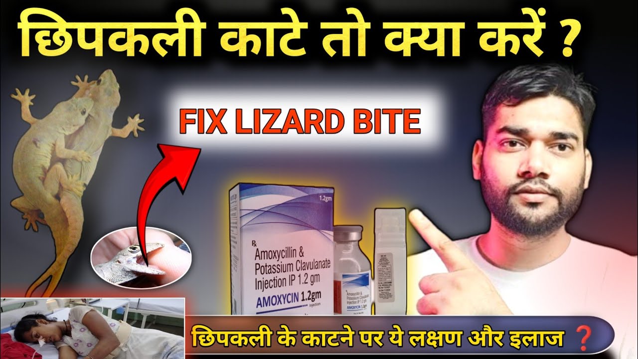 Lizard Bite - First Aid, Symptoms | छिपकली काटे तो ये करें - YouTube