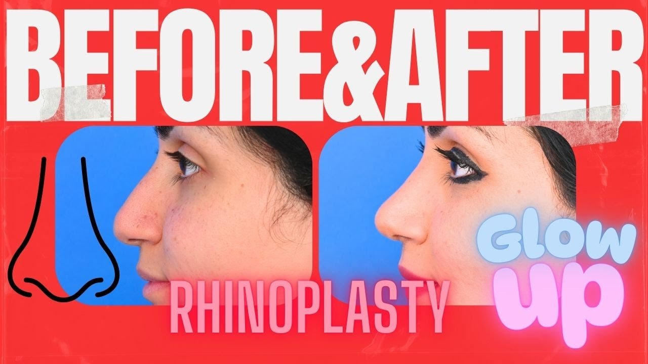 Rhinoplasty Transformation: A Beautiful & Natural Nose Job by Dr ...