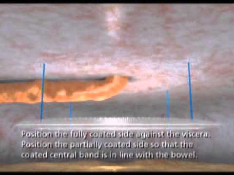 Parietex Parastomal Mesh for parastomal Hernia S MS VD ParietParast GB ...