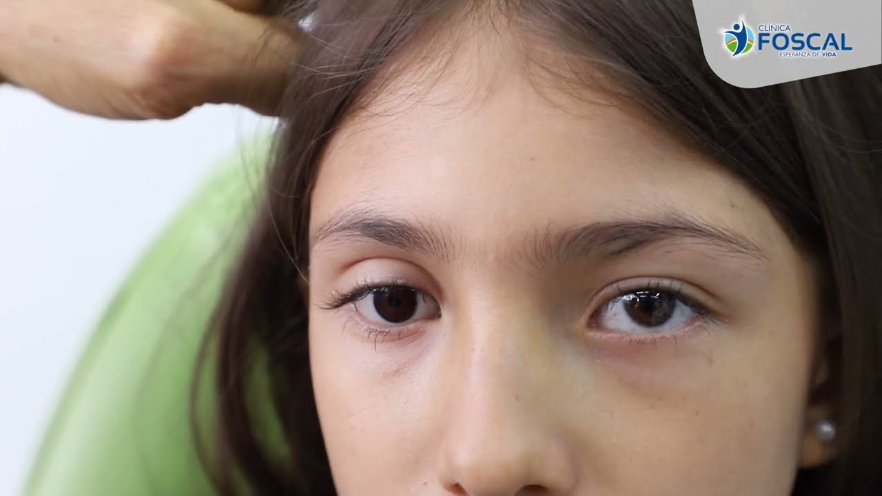 Prótesis ocular, una solución estética y emocional para nuestros ...