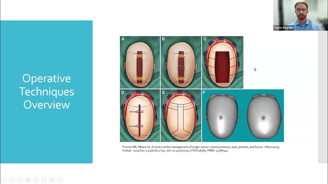 “Management of Lambdoid Craniosynostosis: A Comprehensive & Systematic ...