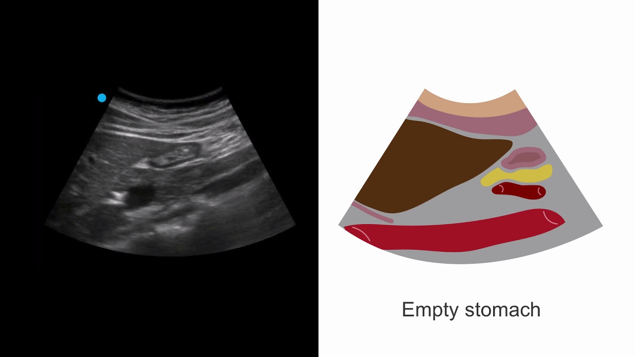 Assessing the stomach for NPO status - YouTube