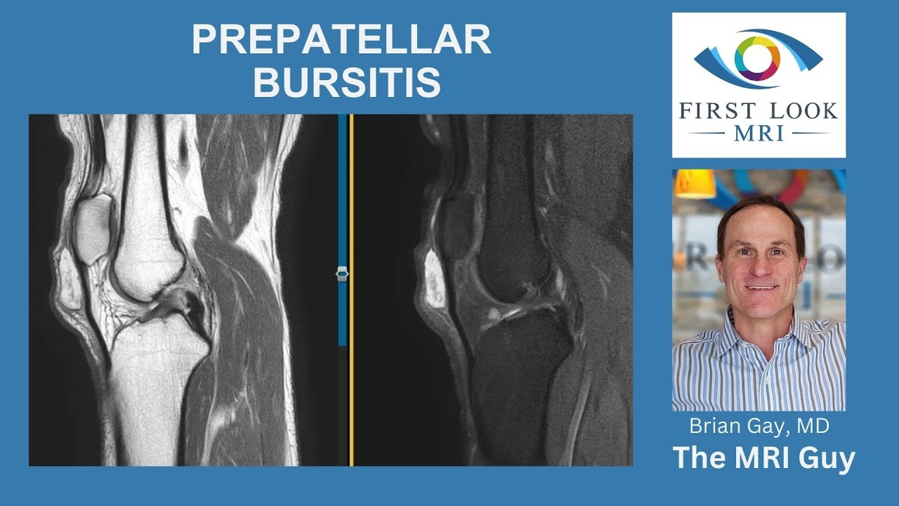 Prepatellar Bursitis - YouTube