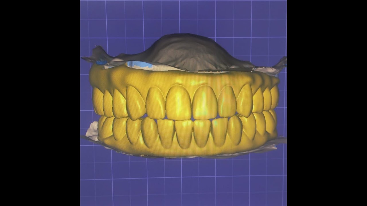 Learning single piece implant prostho Live Stream - YouTube