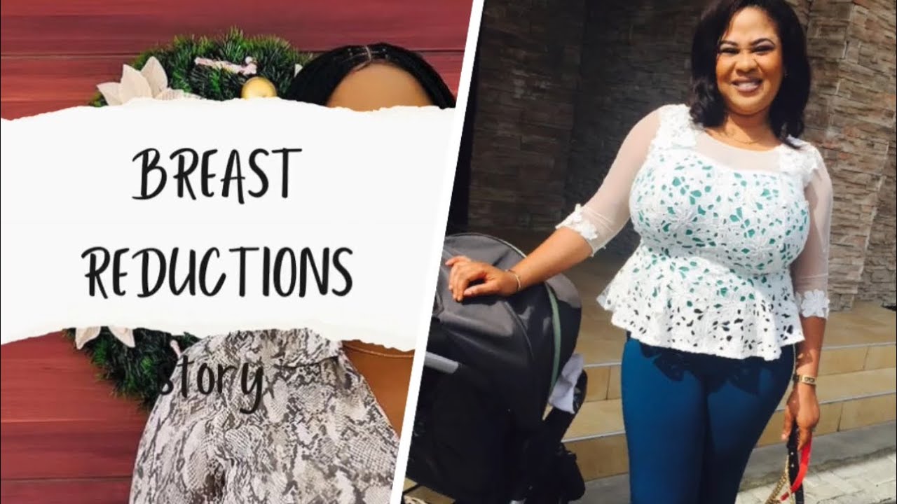MY BREAST REDUCTION STORY | Double plastic surgery and breastfeeding ...