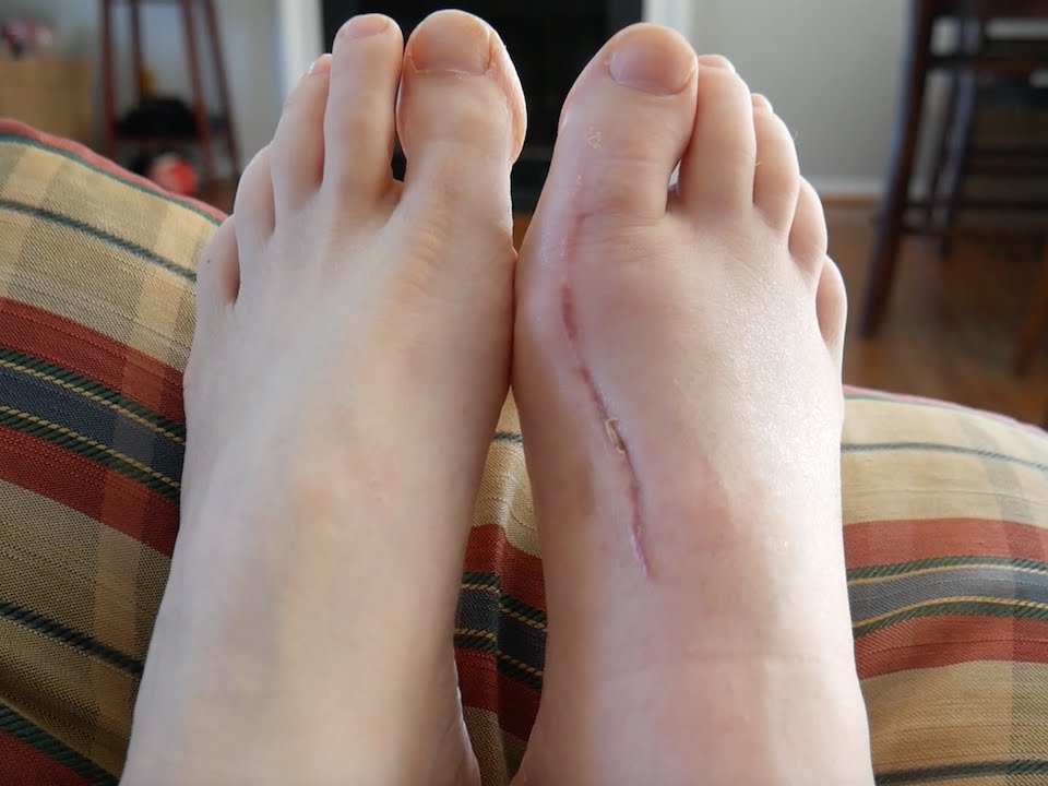Bunion Surgery Recovery Week 8 Walking Driving Again YouTube