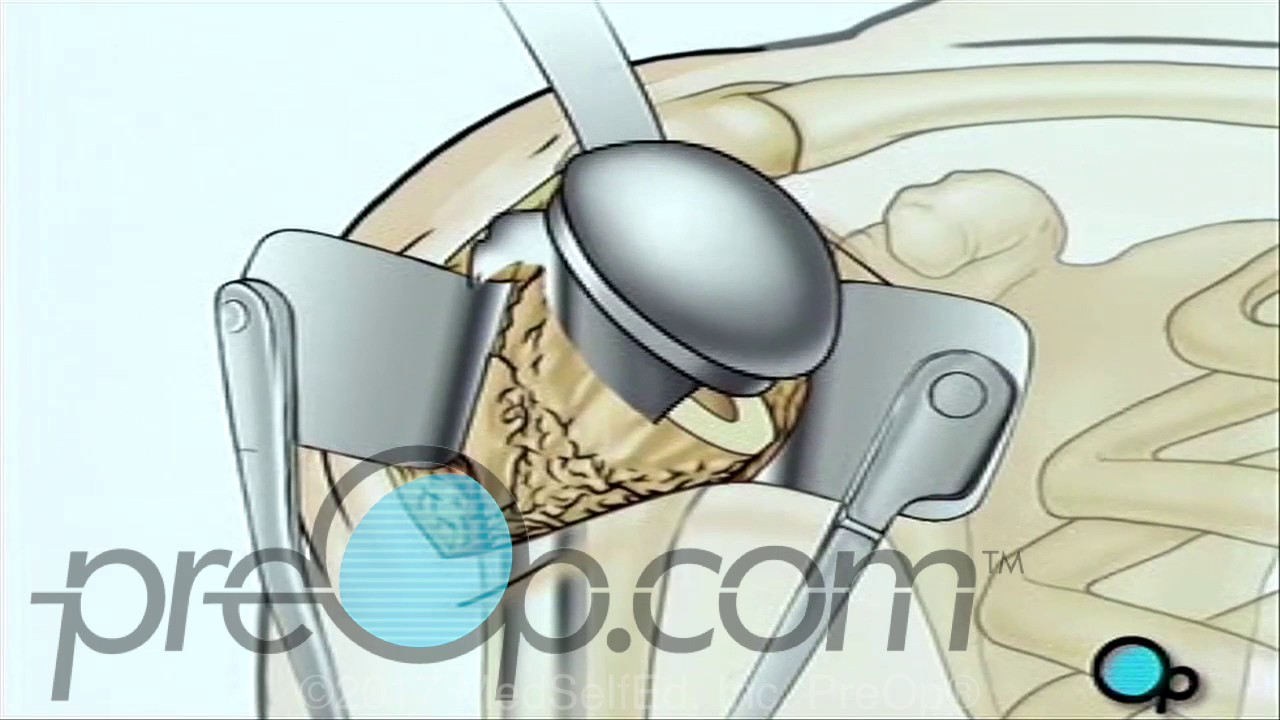Shoulder Joint Replacement Surgery | Patient Education • PreOp.com ...