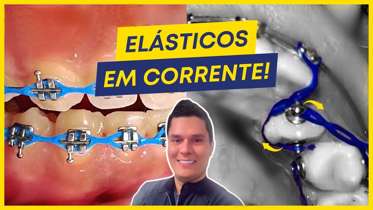 5 FUNÇÕES DOS ELÁSTICOS EM CORRENTE NA ORTODONTIA! - YouTube