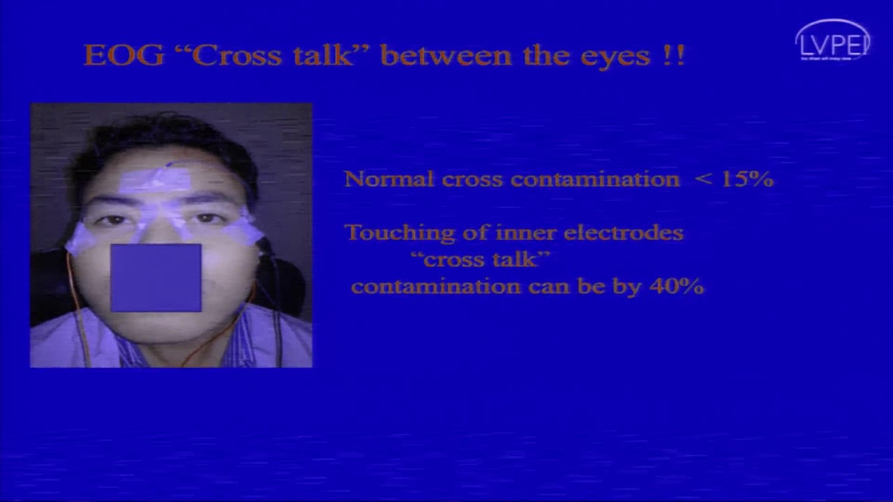 AIOC2018 - GP145 - Topic - Electro-oculogram: Basic principle and ...