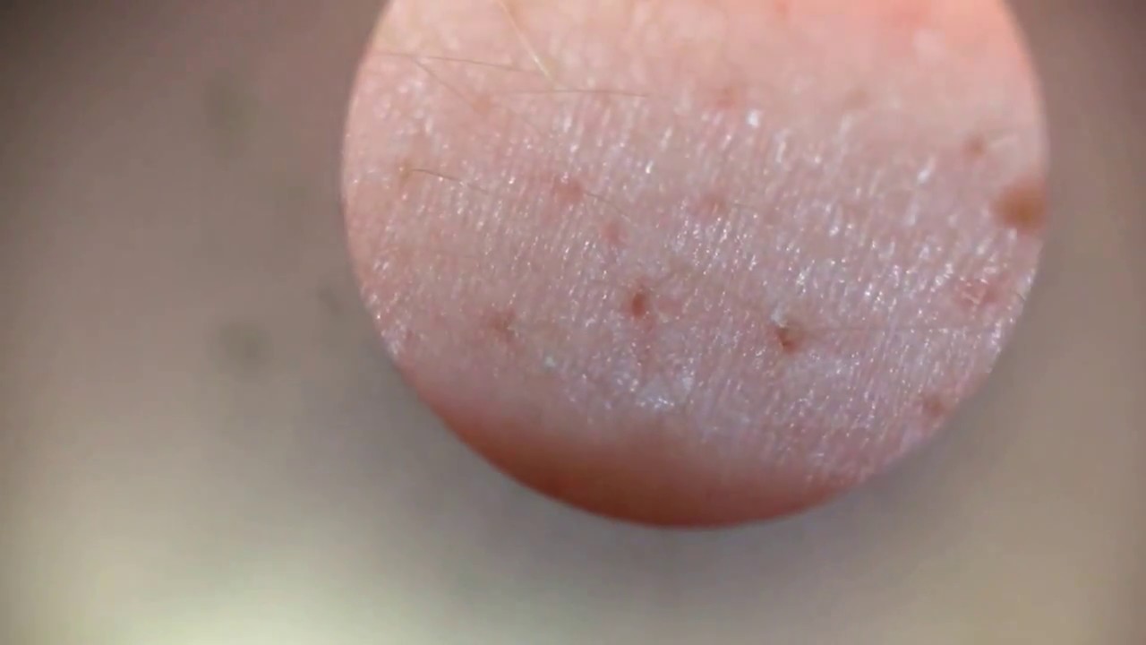 Pushing out comedones on boyfriend's back - YouTube