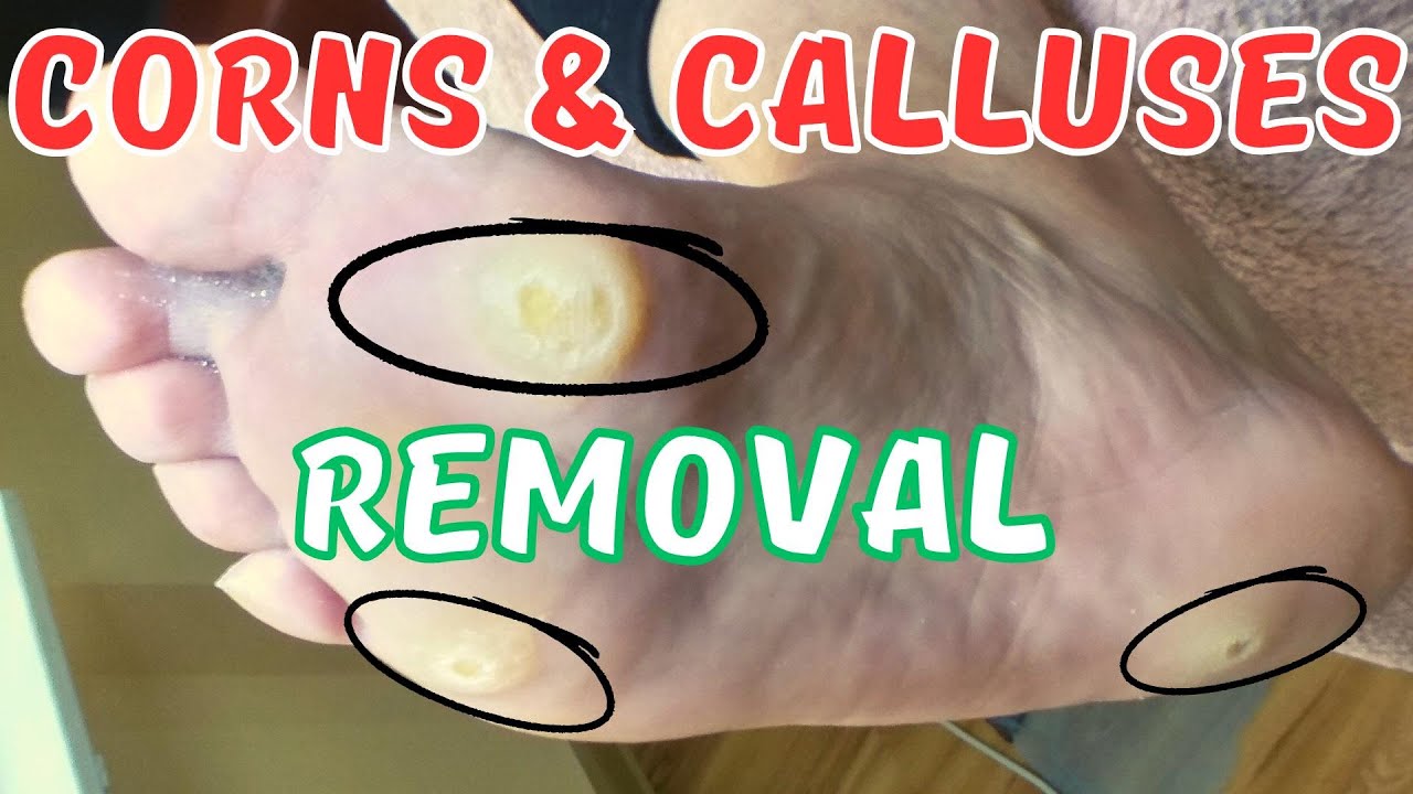 Feet corns and calluses removal. Medical pedicure. - YouTube