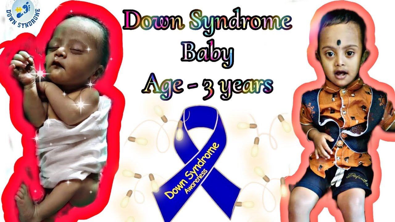 Down Syndrome Baby || Day 1 to 3 years age growth || Hirak Halder || # ...