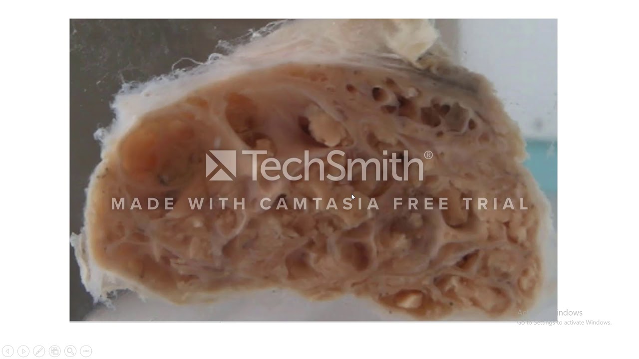 Gross pathology of duct ectasia - YouTube