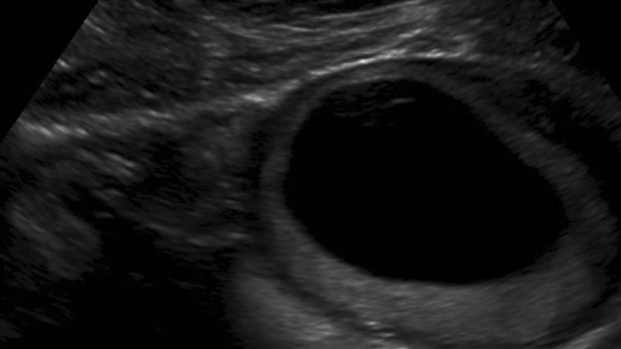 Interstitial Ectopic Pregnancy in a Septate Uterus - YouTube