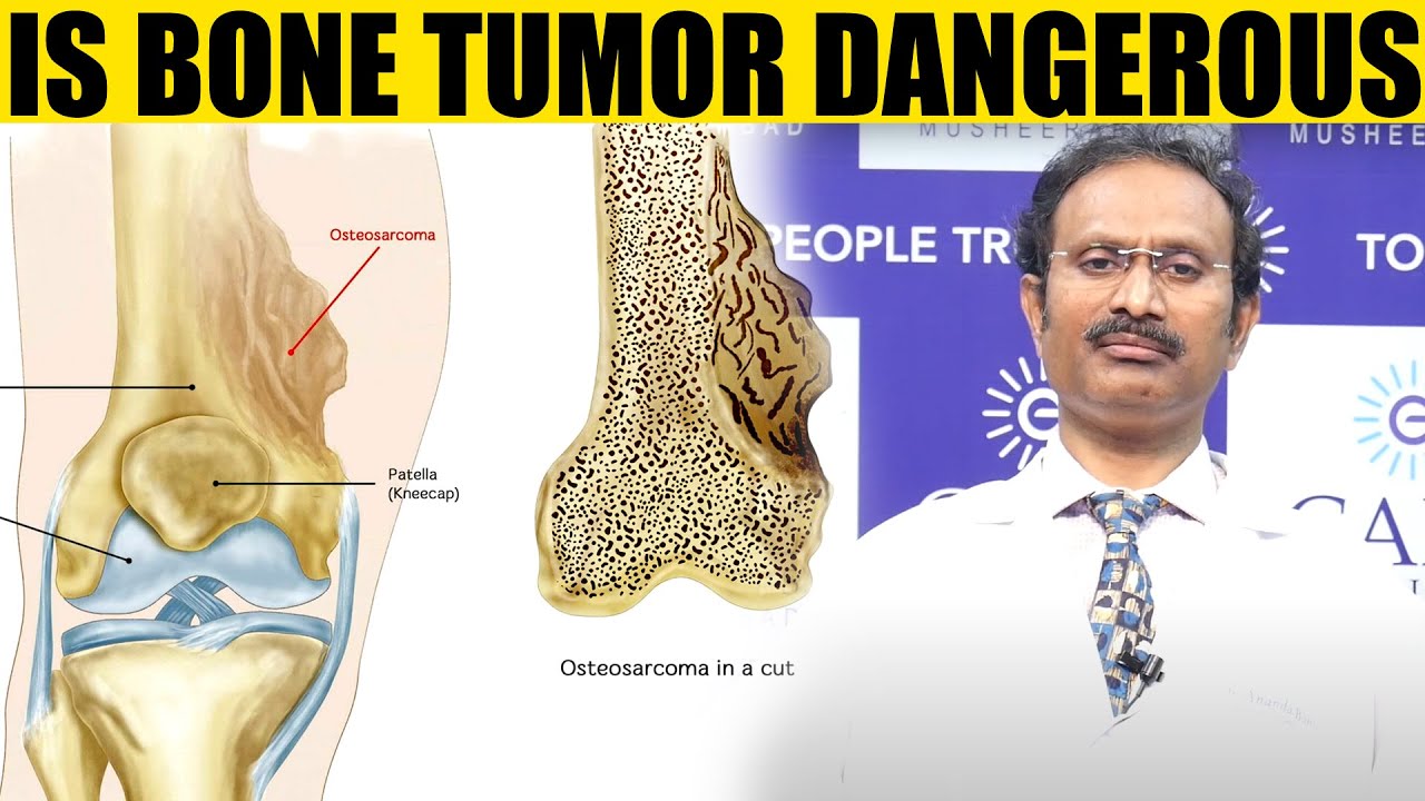 IS BONE TUMOR DANGEROUS | Dr Anand Babu | Orange Health - YouTube