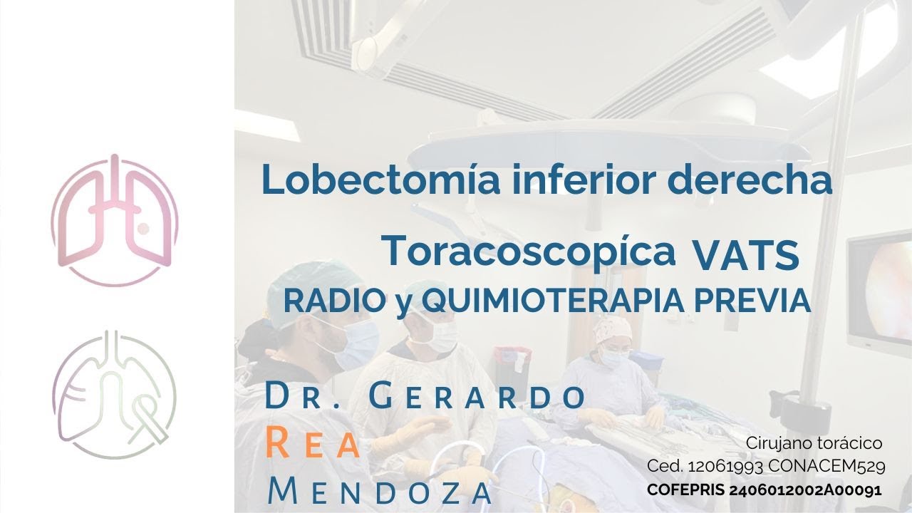 Lobectomía pulmonar POST Radioterapia y Quimioterapa Toracoscópica VATS ...