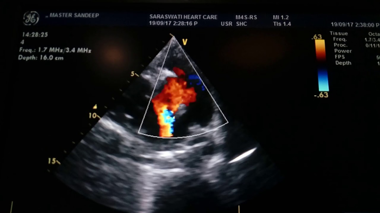 ECHOCARDIOGRAPHY RHD MR AR - YouTube