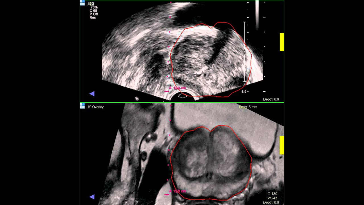 MR US FUSION PROSTATE BIOPSY - YouTube