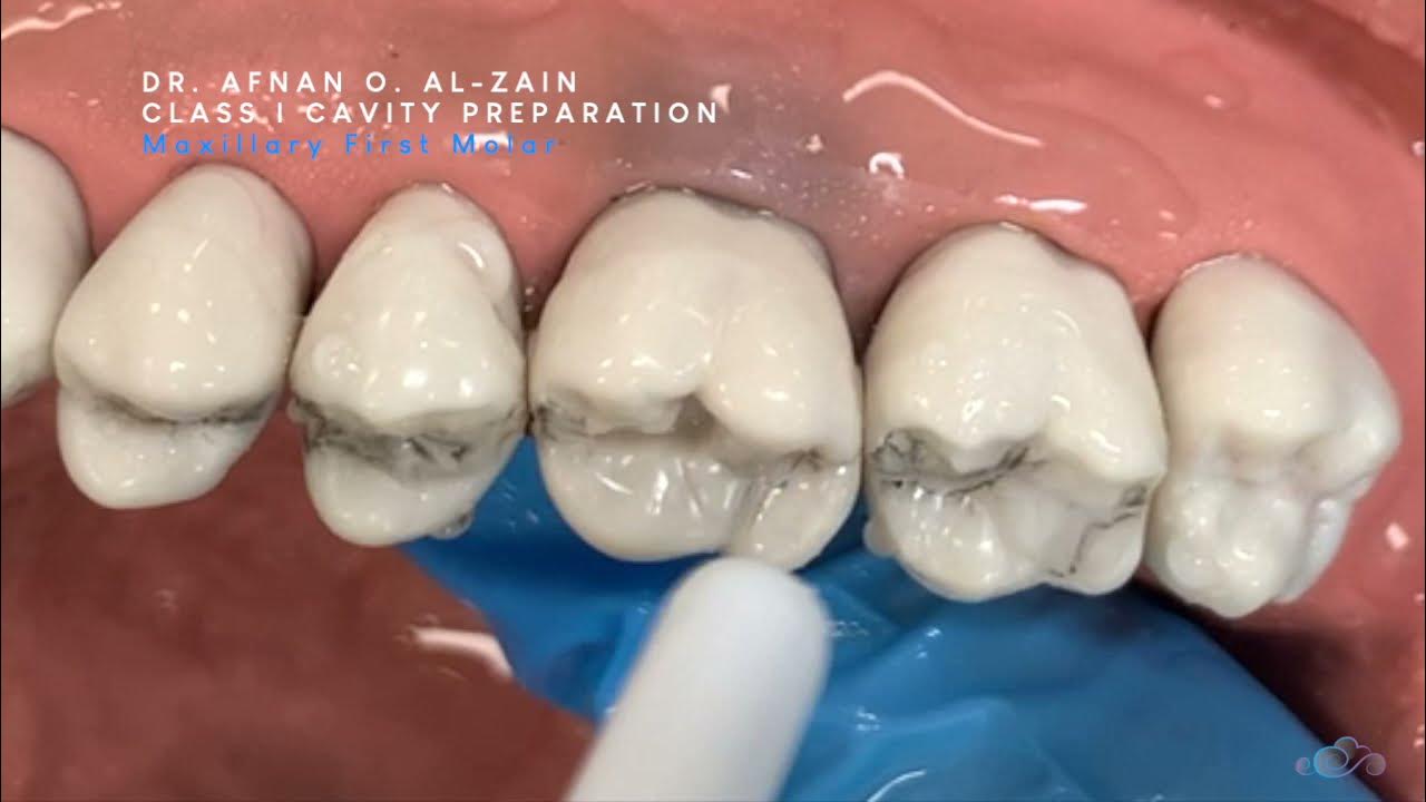 Class I cavity preparation for amalgam - maxillary molar #26 - Preclinical Operative - Arabic ...