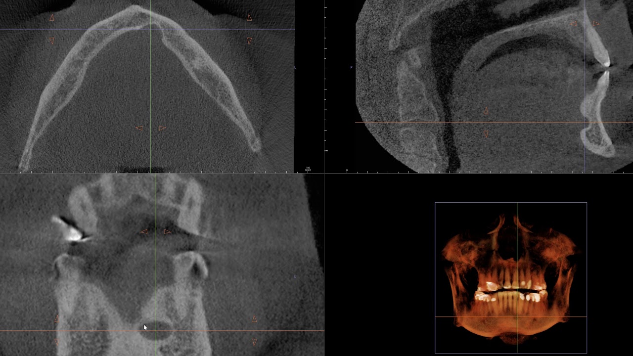 Stafne defect rare anterior variant - YouTube