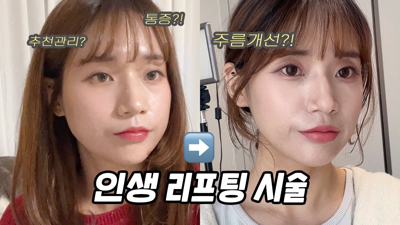 인생 리프팅 시술 발견💡 텐써마리프팅 효과 이렇게나 좋다고⁉️ 고통 전후비교 인모드 시술 비교 추천ㅣ피부과 시술 브이로그