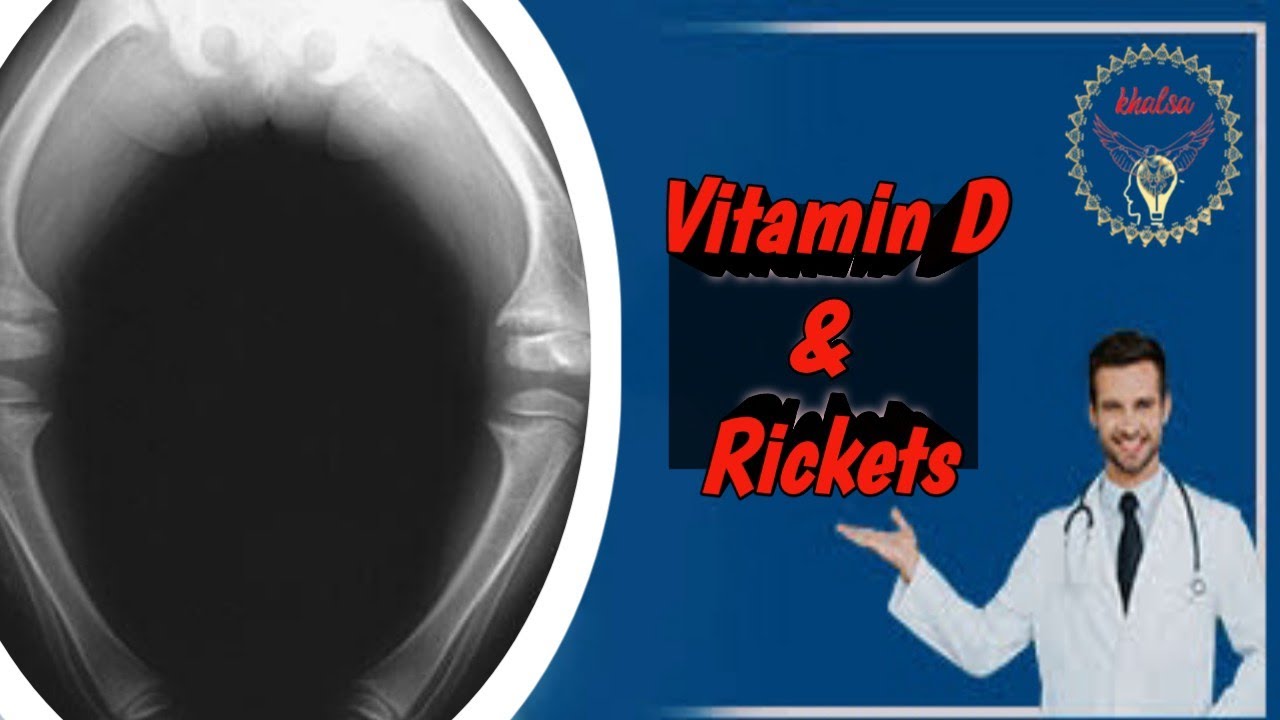 13. Vitamin D & Rickets ( Pediatric ) - YouTube