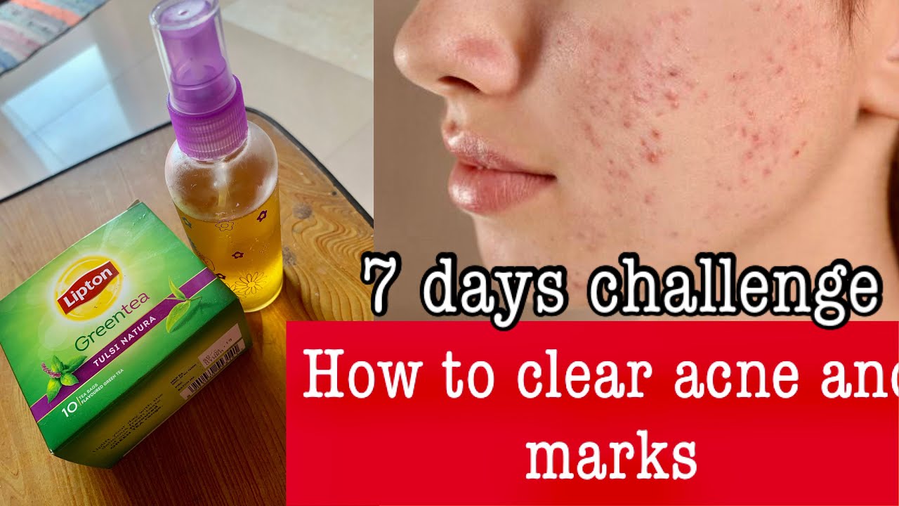 How To Remove Pimples On Face How To Clear Acne And Acne Marks On