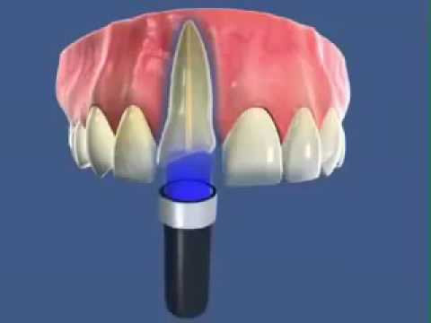 Endodontia- Pinos Intra-Radiculares Anatômicos - YouTube
