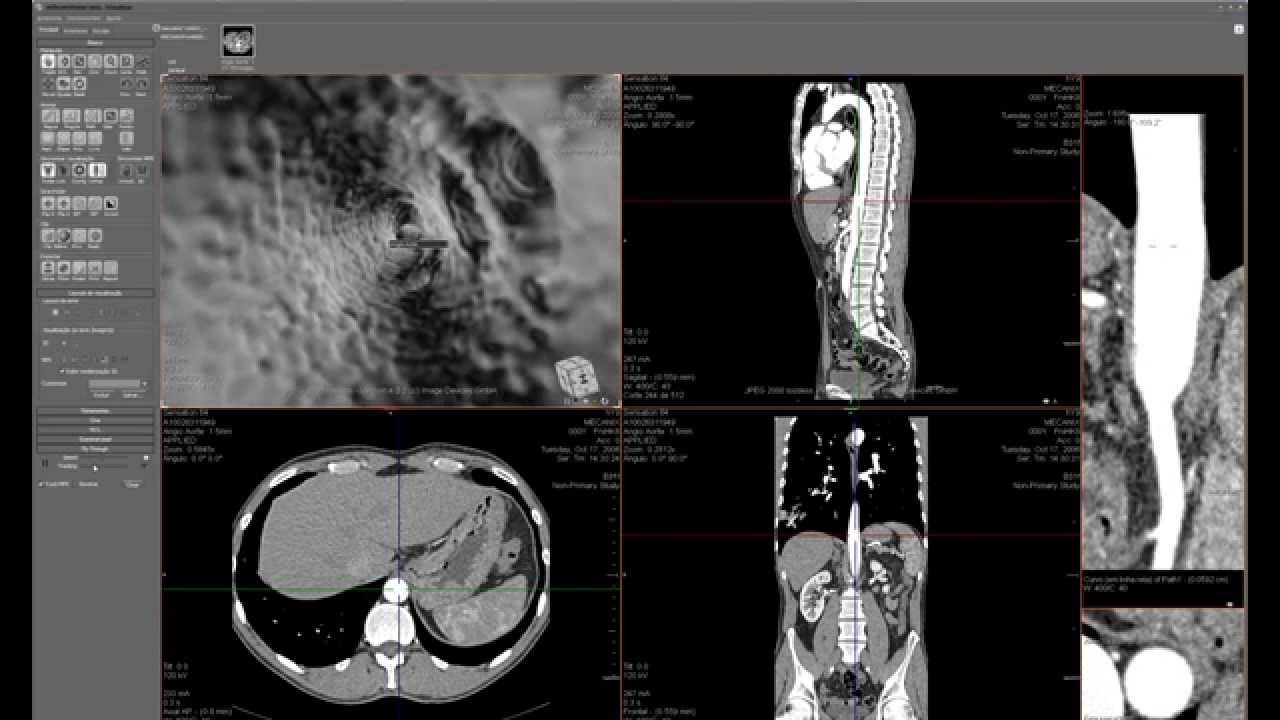 Endoscopia Virtual - YouTube
