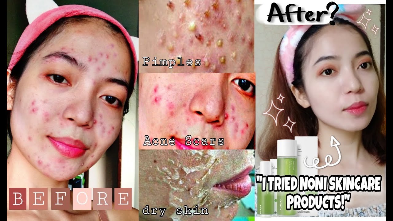 GETTING RID OF MY PIMPLES DARKSPOTS ACNE DRY & SENSITIVE SKIN USING "THE REAL NONI DUO" BY ...