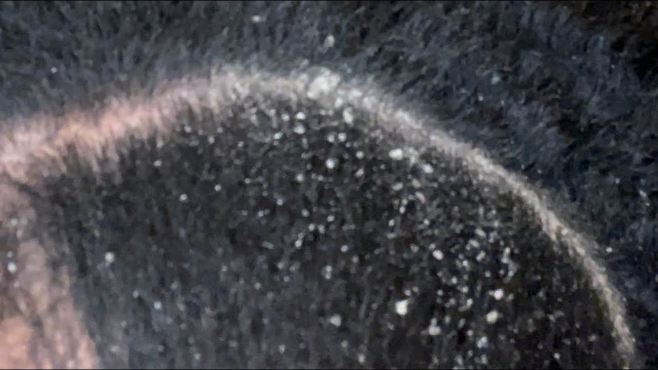 Dandruff Scratching Scaly Patches Seborrheic Eczema Scalp Flareup - YouTube