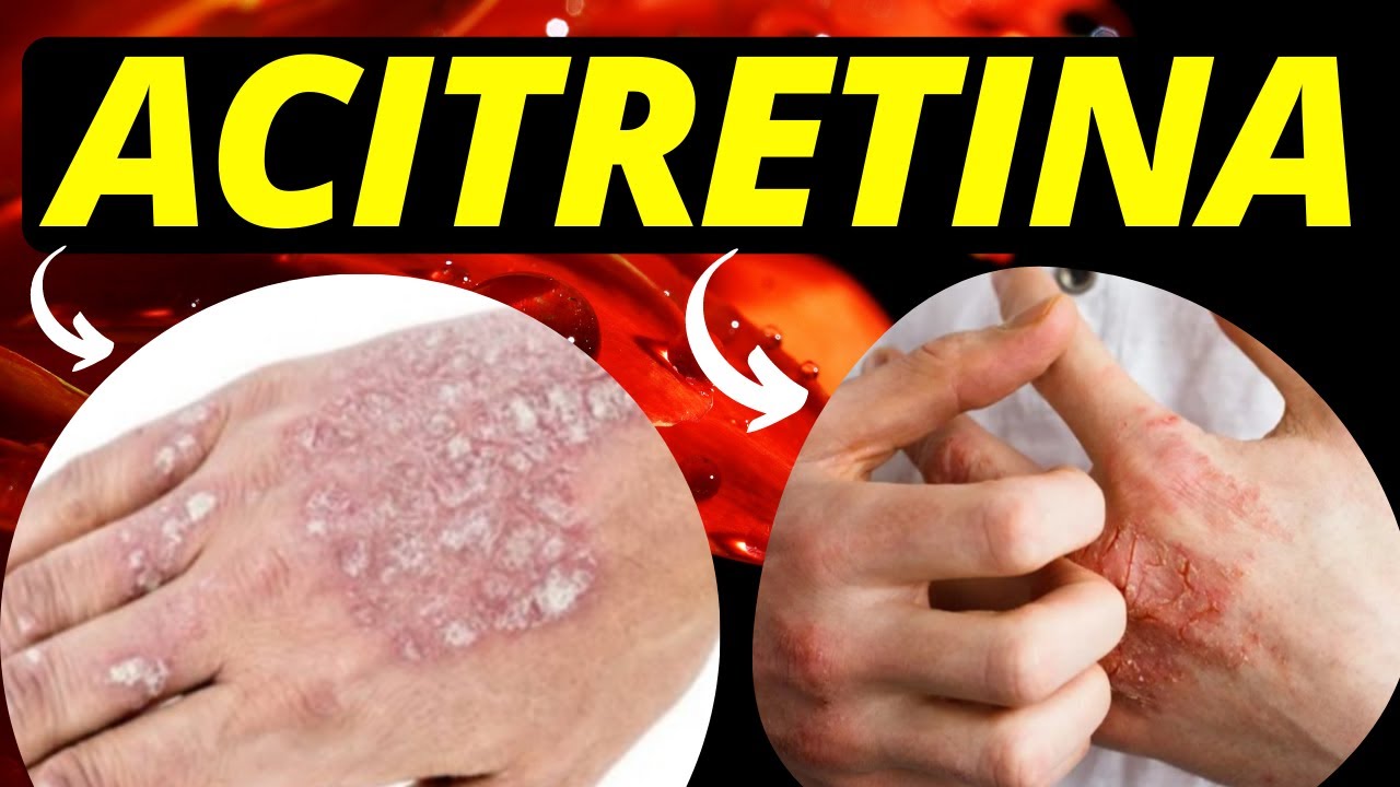 ACITRETINA: apresentação, mecanismo de ação, indicação, reações e ...