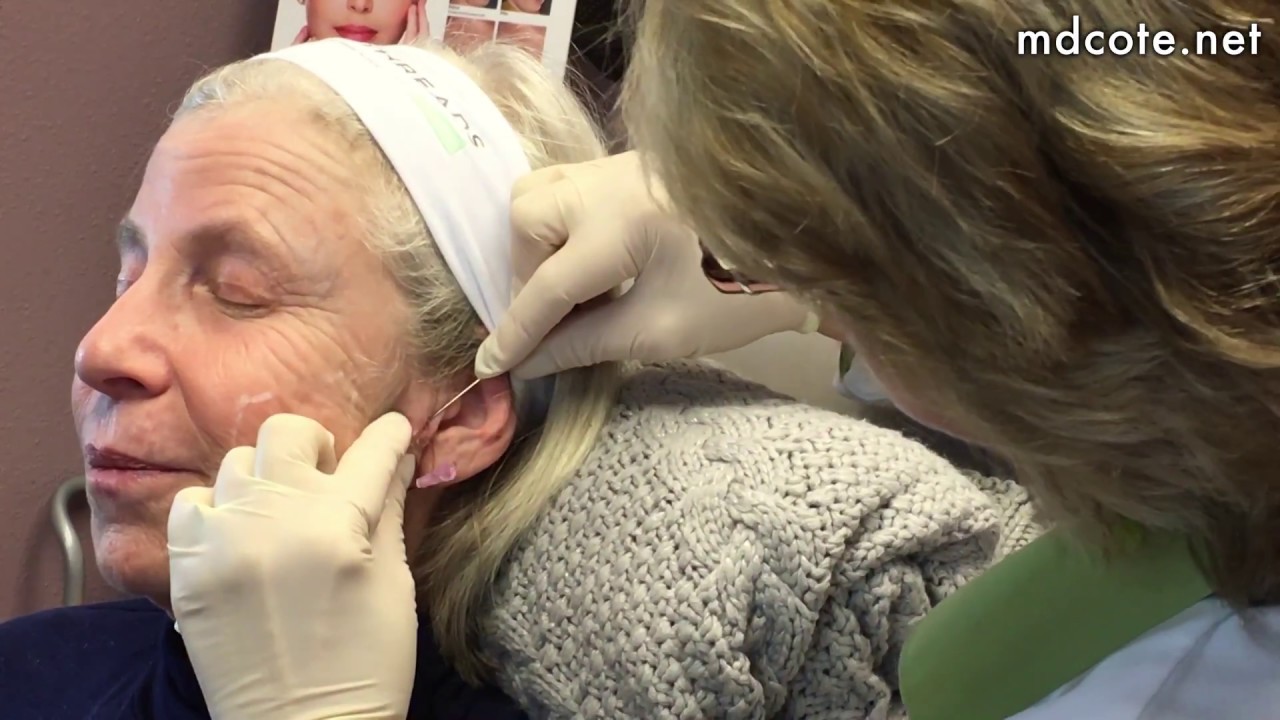 Nova Threads for Neck and Jawline Lifting - YouTube