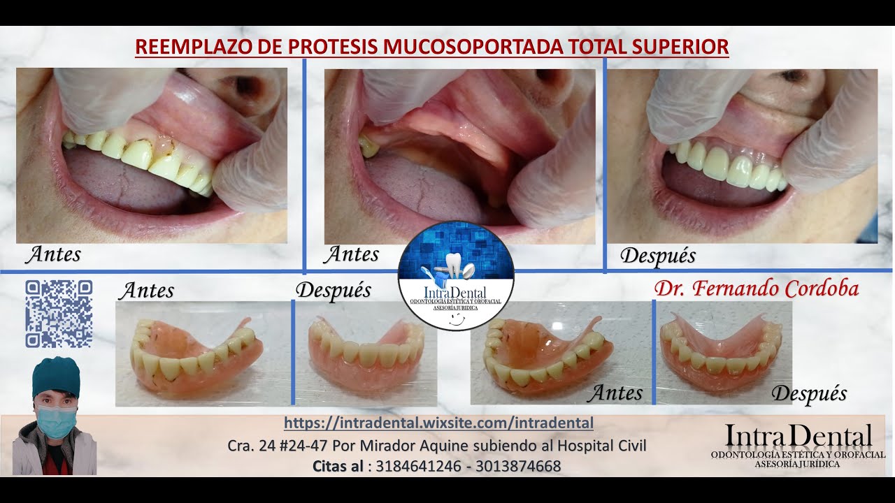 prótesis total superior mucosoportada - YouTube