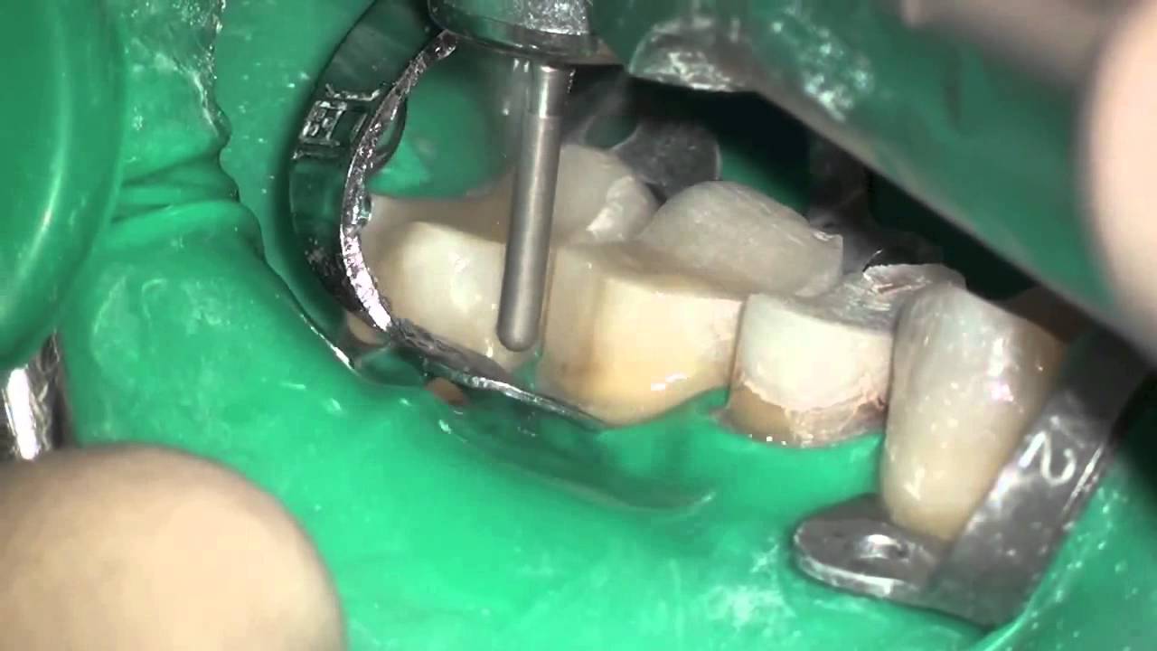 Tooth preparation with microscope. (molar and premolar). Rub - YouTube