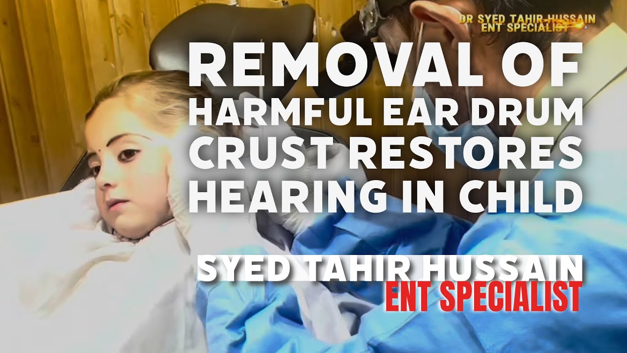 Removal of Harmful Ear Drum Crust Restores Hearing in Child | Effective ...