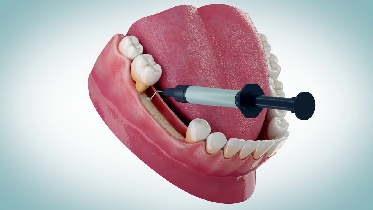 Bone regeneration- dental 3d animation - YouTube