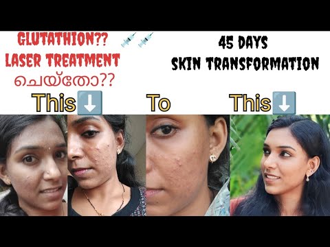45 Days Skin Transformation || My 8 Years Acne Journey - YouTube