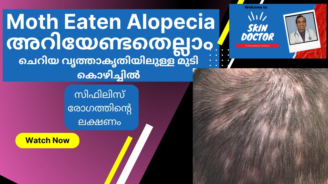 Moth eaten Alopecia malayalam ചെറിയ വൃത്താകൃതിയിലുള്ള മുടി കൊഴിച്ചി ...