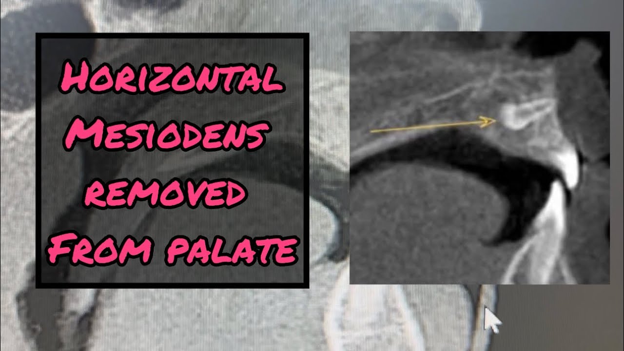 Horizontal Mesiodens Removal from Palate Step-by-Step - YouTube
