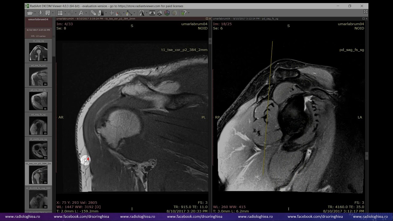 Caz umăr labrum 04 explicat - YouTube