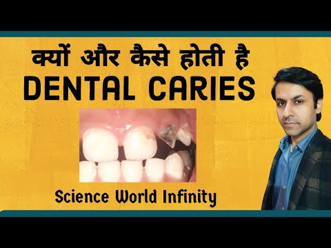 How pH relate with dental caries | Dental caries | Dental care | # ...
