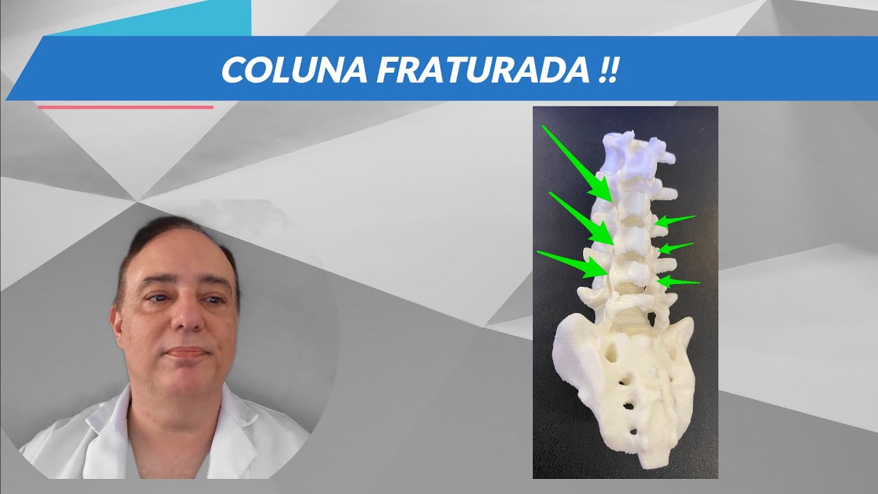 Coluna fraturada - Como se Diagnostica e Tratamento - YouTube