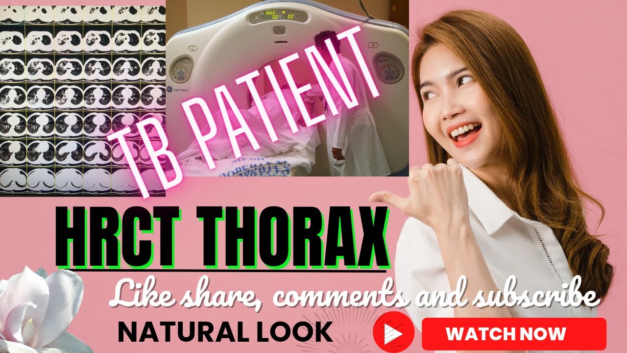 HRCT THORAX | TB | Mycobacterium Tuberculosis | CT chest/Lungs | full ...