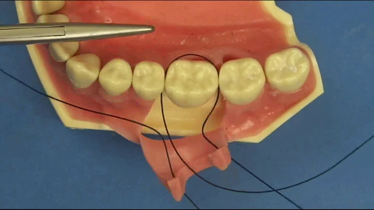 Single Sling Buccal Approach - YouTube