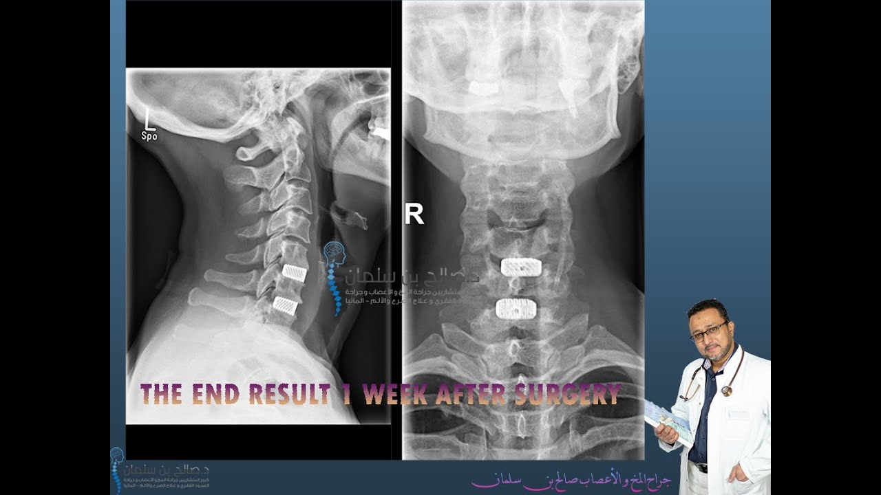 cervical spinal canal osteophyte Microsurgery / Saleh Bin Salman - YouTube