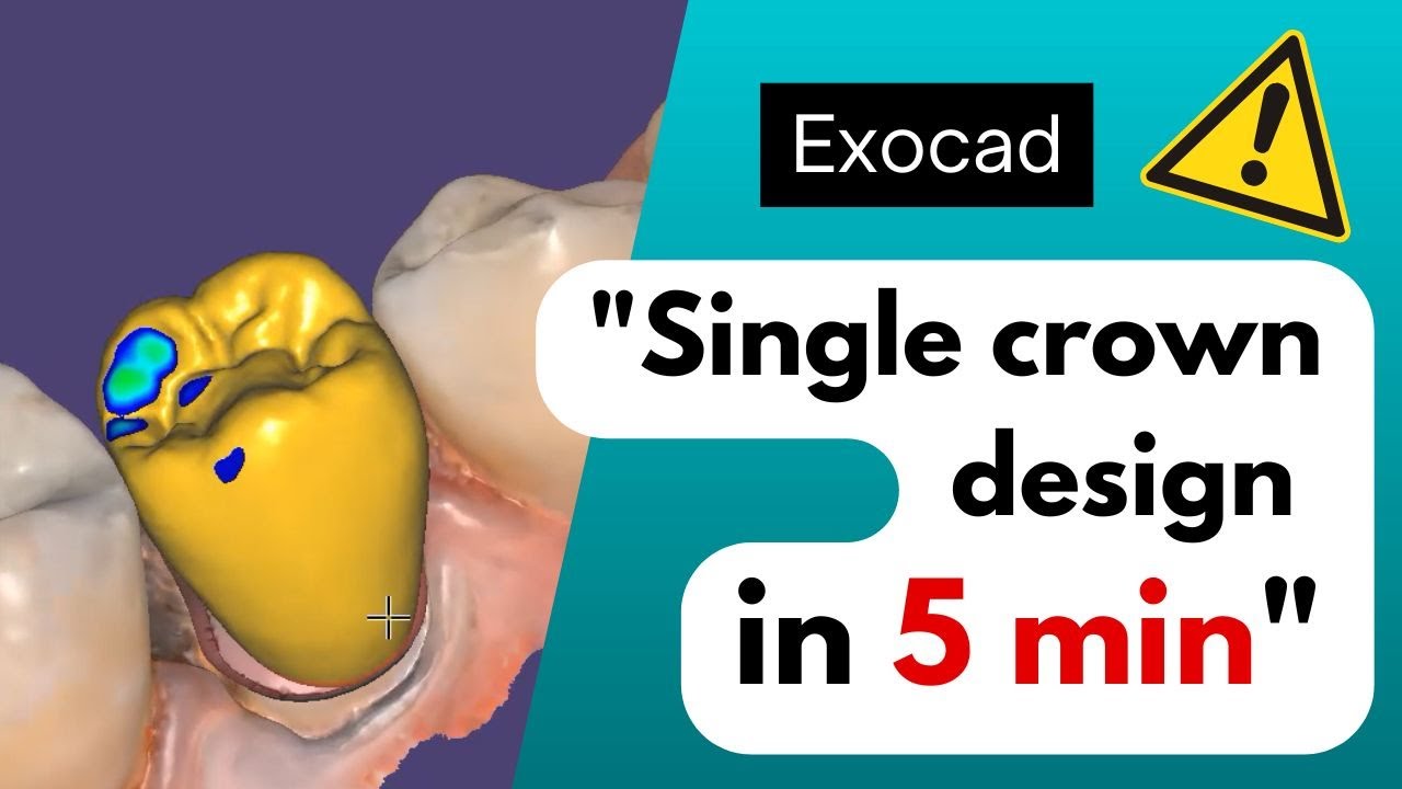 Single Crown Design in Exocad – Under 5 Minutes! - YouTube