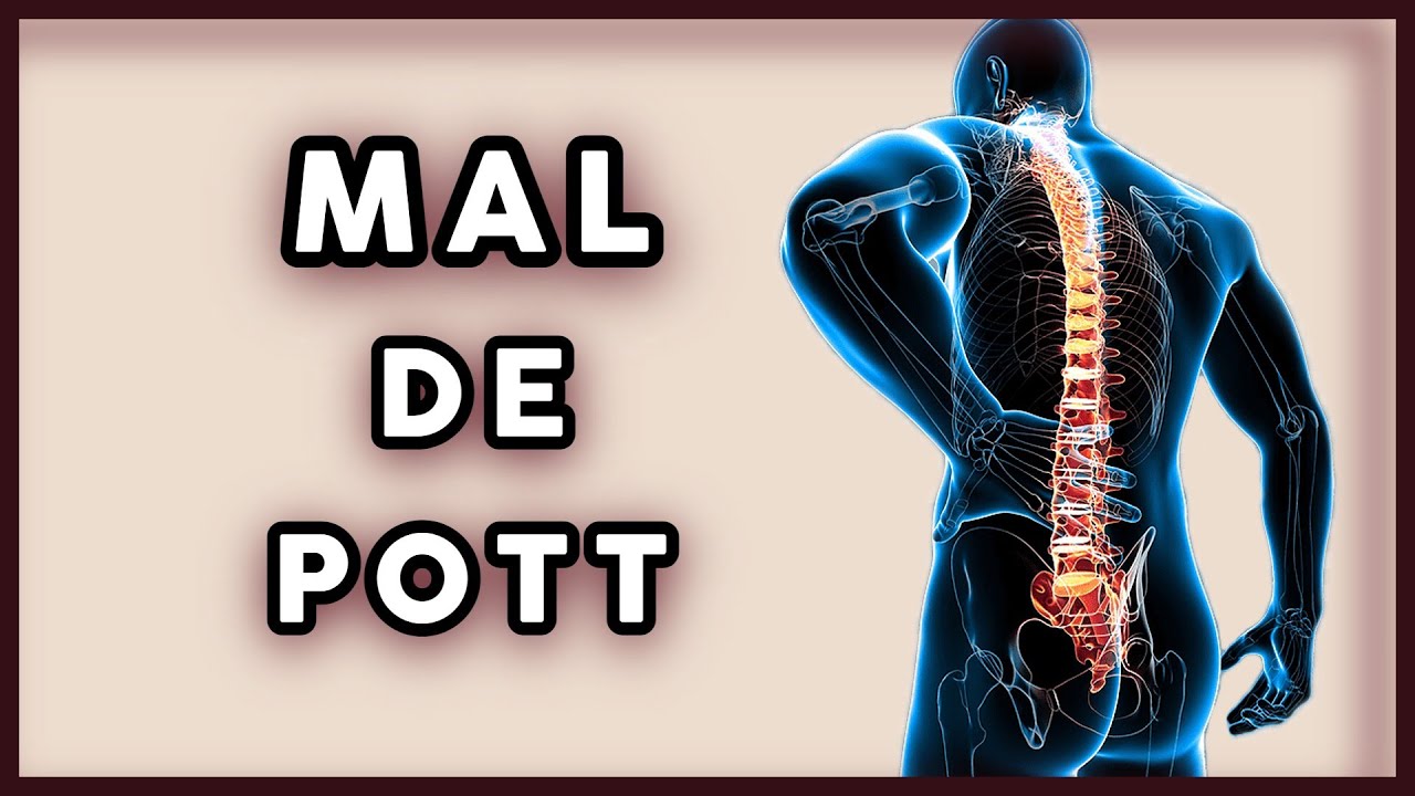 Tuberculosis vertebral - Mal de Pott - YouTube